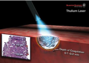 Thulium (Thulep) Method for BPH - Southeast Valley Urology